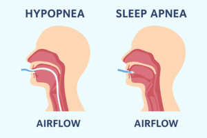 Hypopnea vs Sleep Apnea: Understanding the Key Differences - By Jeremy ...