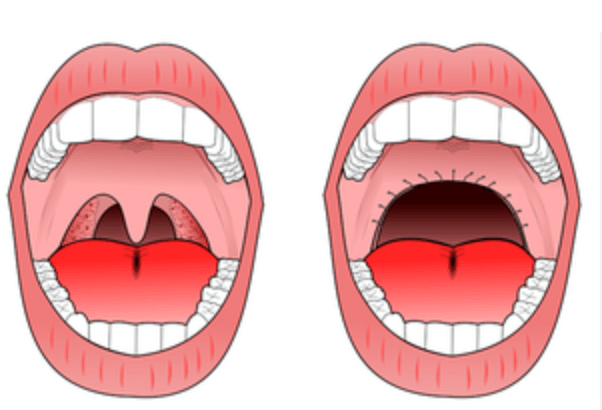 A Comprehensive Guide of UPPP for Sleep Apnea - By Jeremy Smith